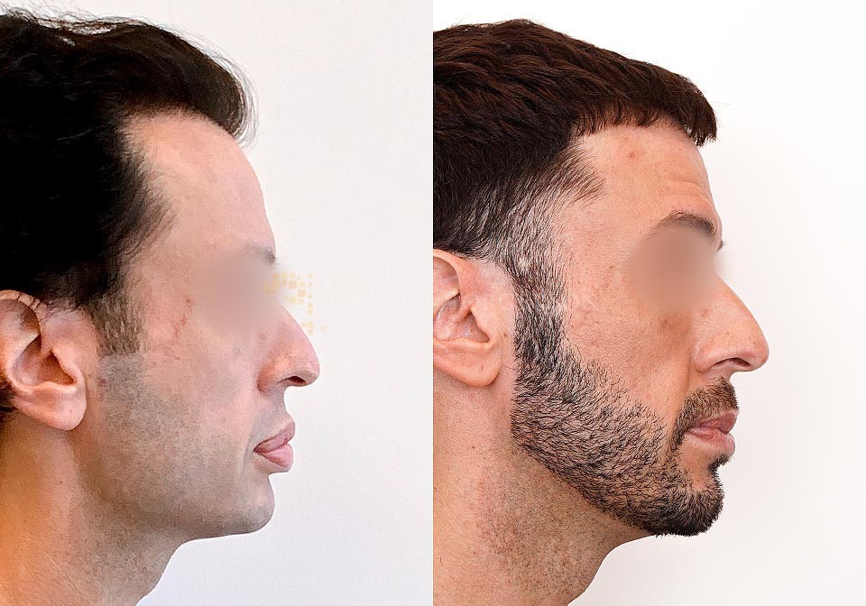 Lip Reduction Before & After Gallery | Dr. Cory Torgerson