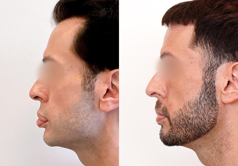 Lip Reduction Before & After Gallery | Dr. Cory Torgerson