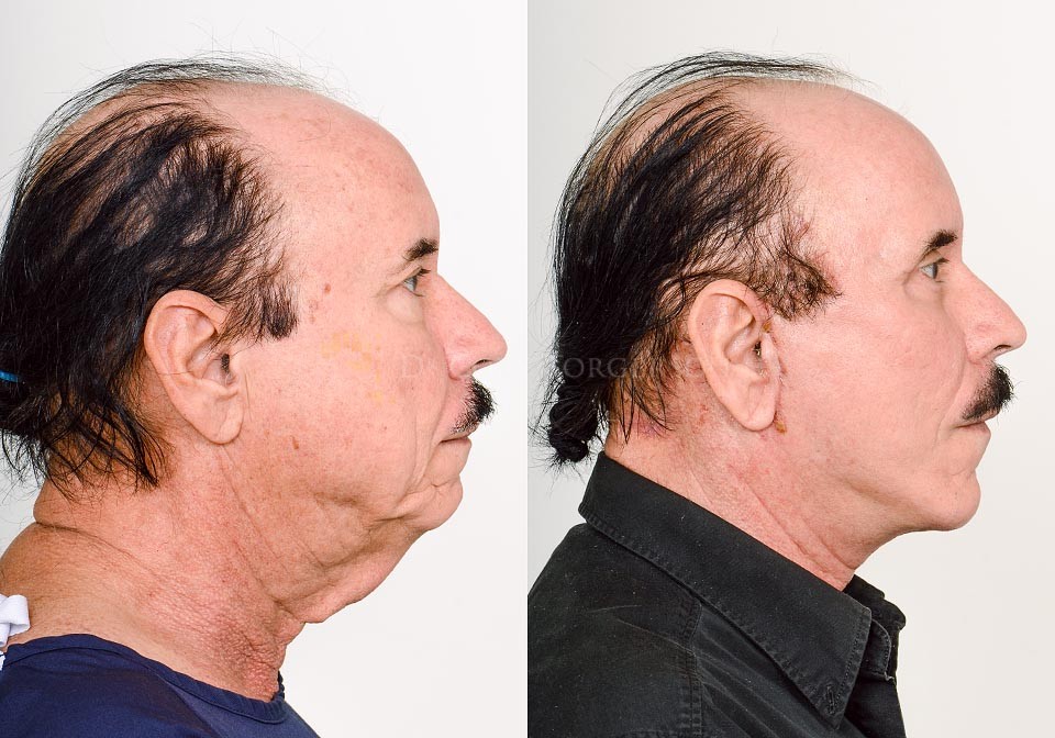 Neck Lift Photos | Before and After Profile Results