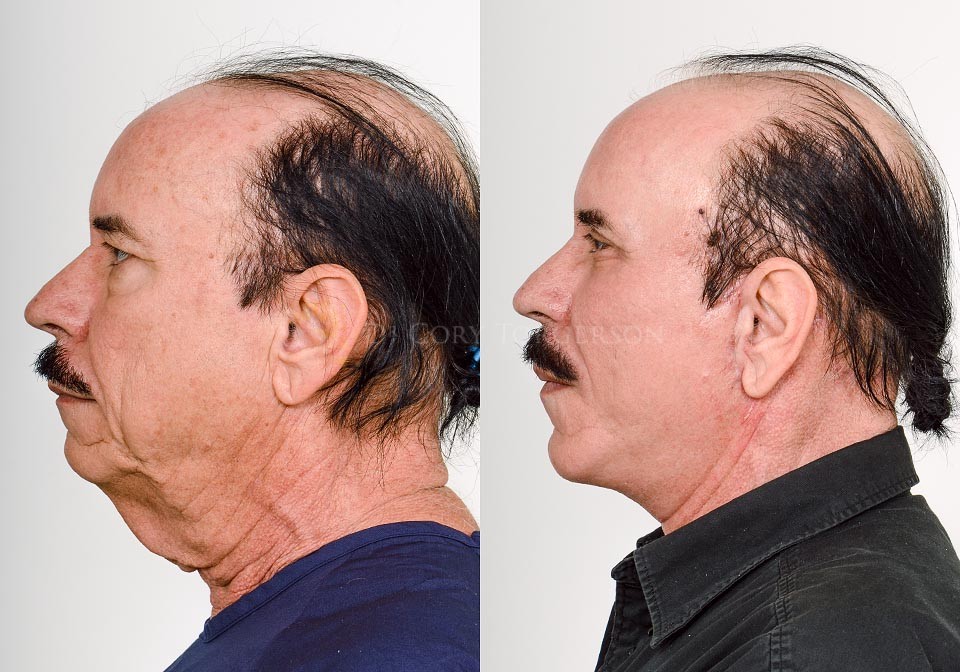 Neck Lift Photos | Before and After Profile Results