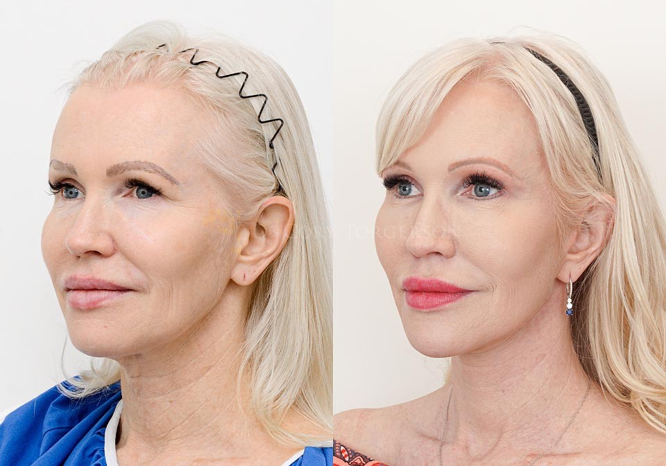 Neck Lift Before & After Gallery | Dr. Cory Torgerson