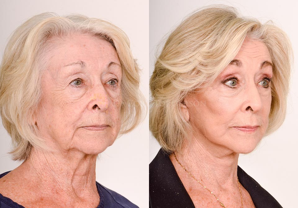 Neck Lift Before & After Gallery | Dr. Cory Torgerson