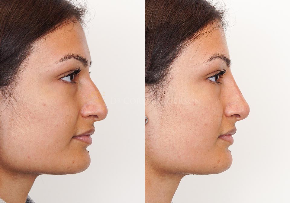 Non Surgical Nose Job Before & After Gallery | Dr. Cory Torgerson