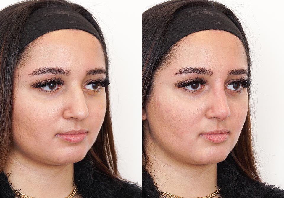 Non Surgical Nose Job Before & After Gallery | Dr. Cory Torgerson