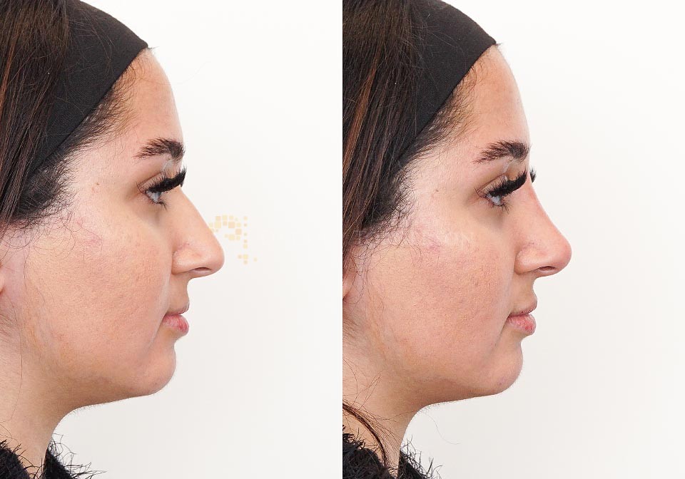 Non Surgical Nose Job Before & After Gallery | Dr. Cory Torgerson