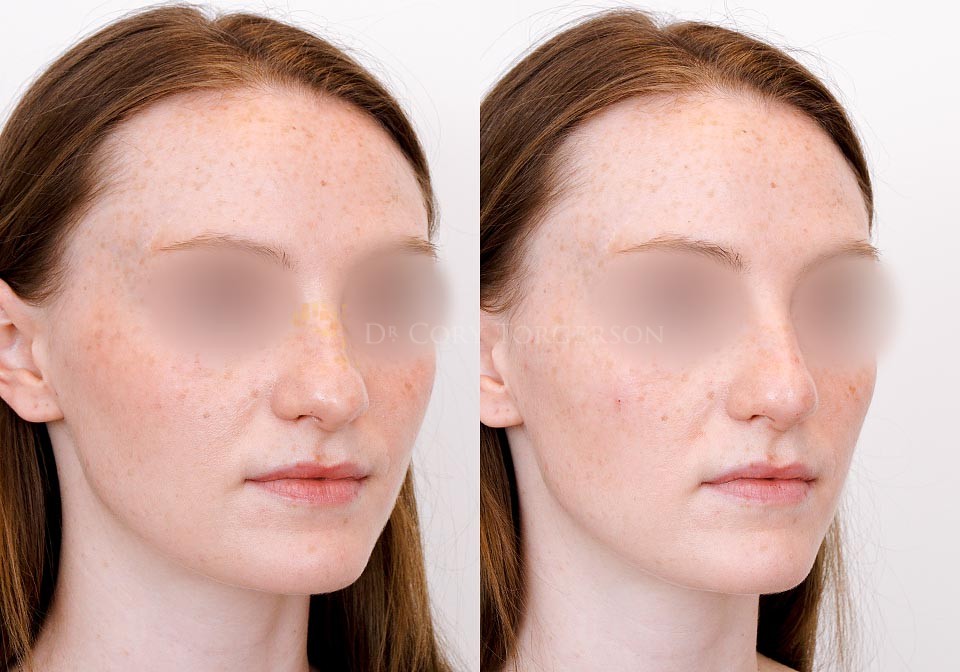 Non Surgical Nose Job Before & After Gallery | Dr. Cory Torgerson
