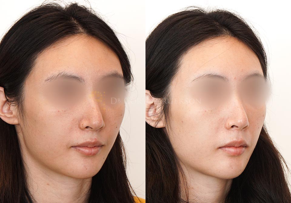 SilkPeel Photos | Advanced Dermal Infusion Photo Album