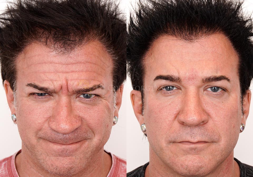 Neuromodulator Before & After Gallery | Dr. Cory Torgerson