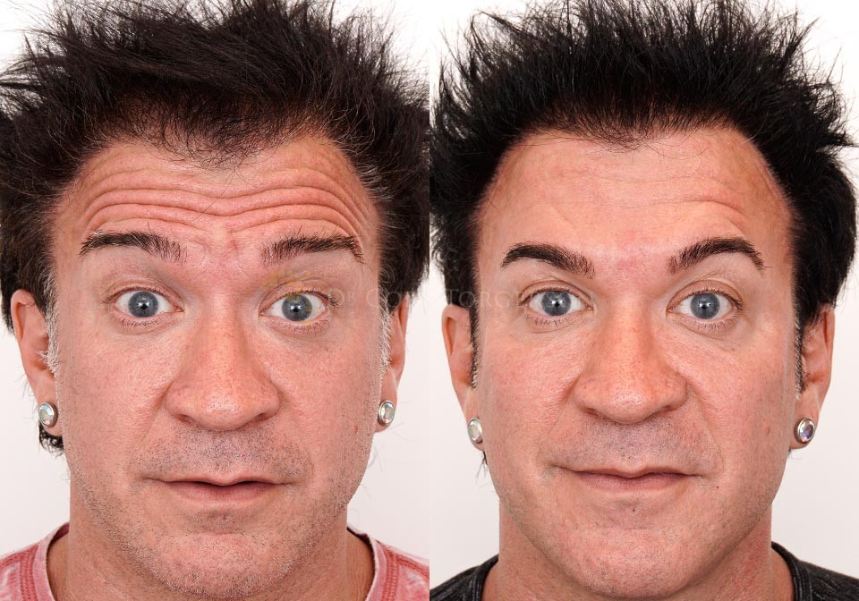 Neuromodulator Before & After Gallery | Dr. Cory Torgerson