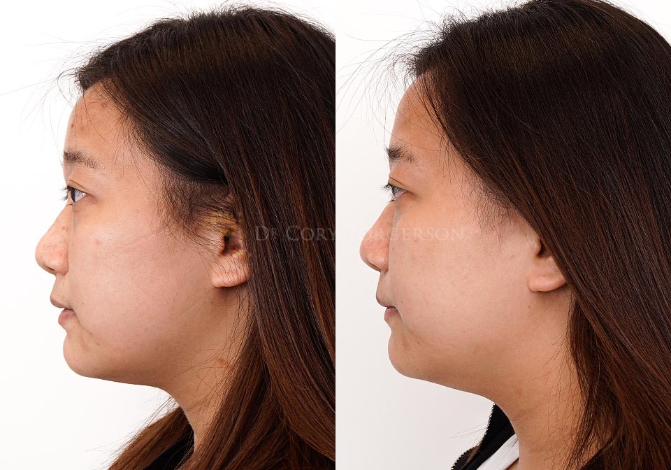 Laser Green Toning Before & After Gallery | Dr. Cory Torgerson