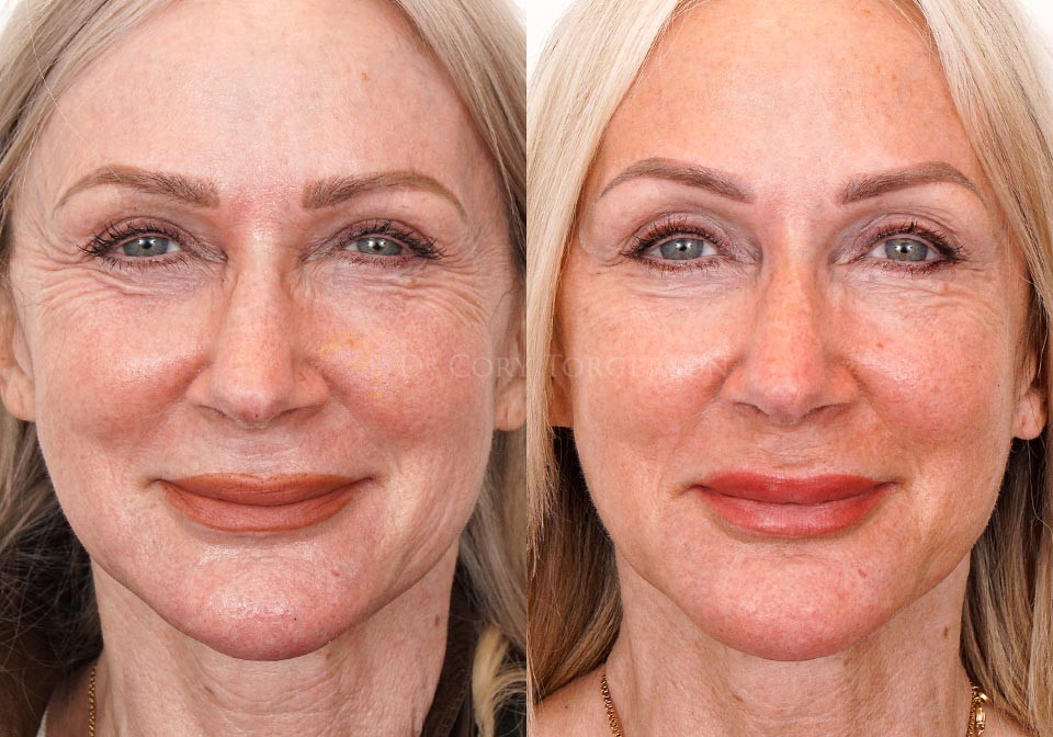 Neuromodulator Before & After Gallery | Dr. Cory Torgerson