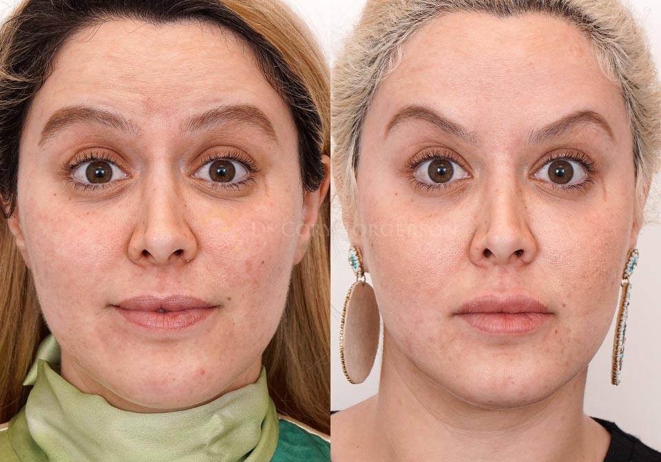 Neuromodulator Before & After Gallery | Dr. Cory Torgerson