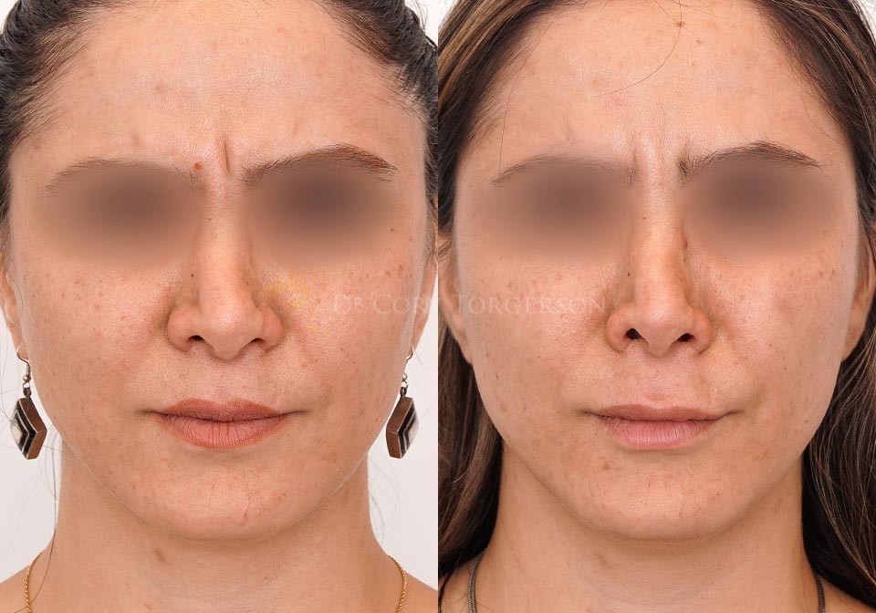 Neuromodulator Before & After Gallery | Dr. Cory Torgerson