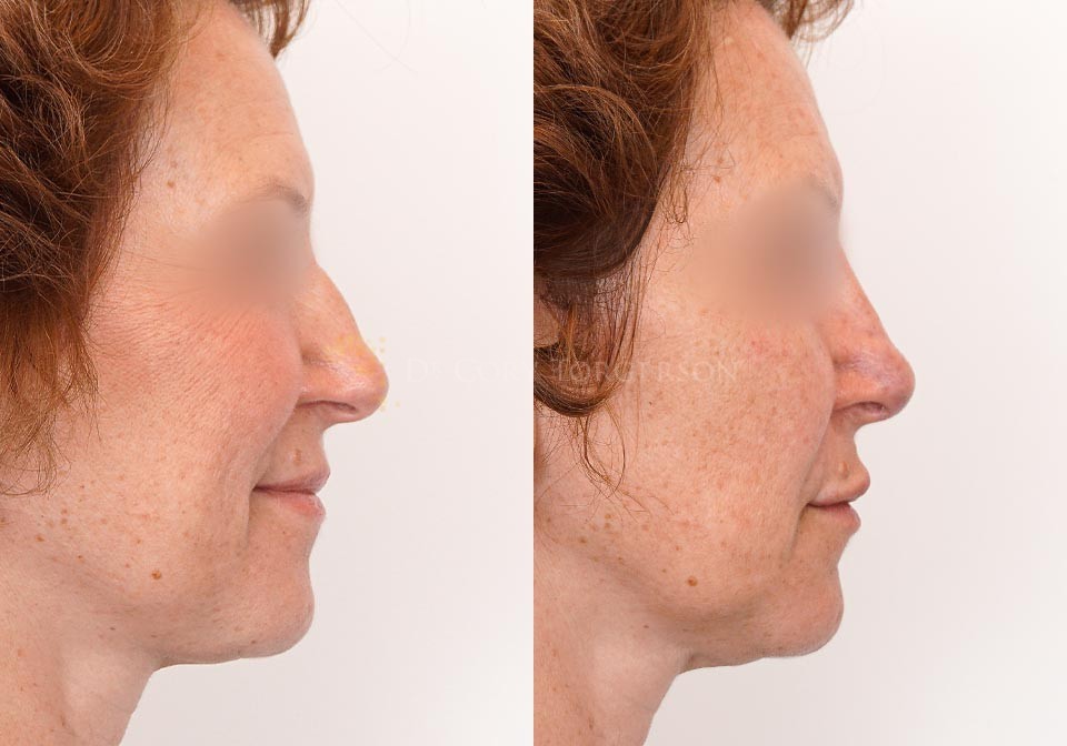 Non Surgical Nose Job Before & After Gallery | Dr. Cory Torgerson