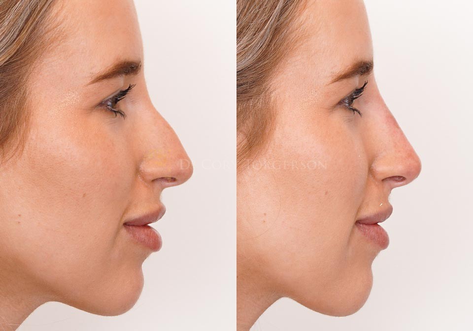 Non Surgical Nose Job Before & After Gallery | Dr. Cory Torgerson
