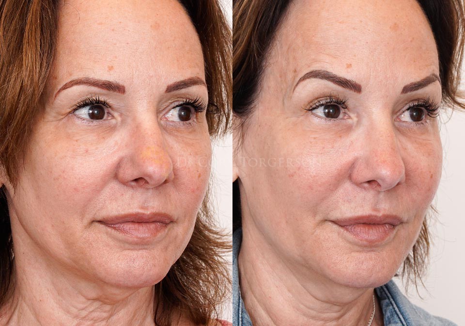 Ultherapy Before & After Gallery | Dr. Cory Torgerson