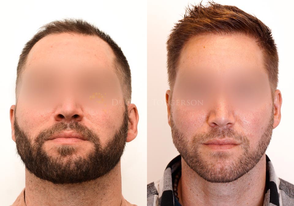 FUE Hair Transplant Before & After Gallery | Dr. Cory Torgerson