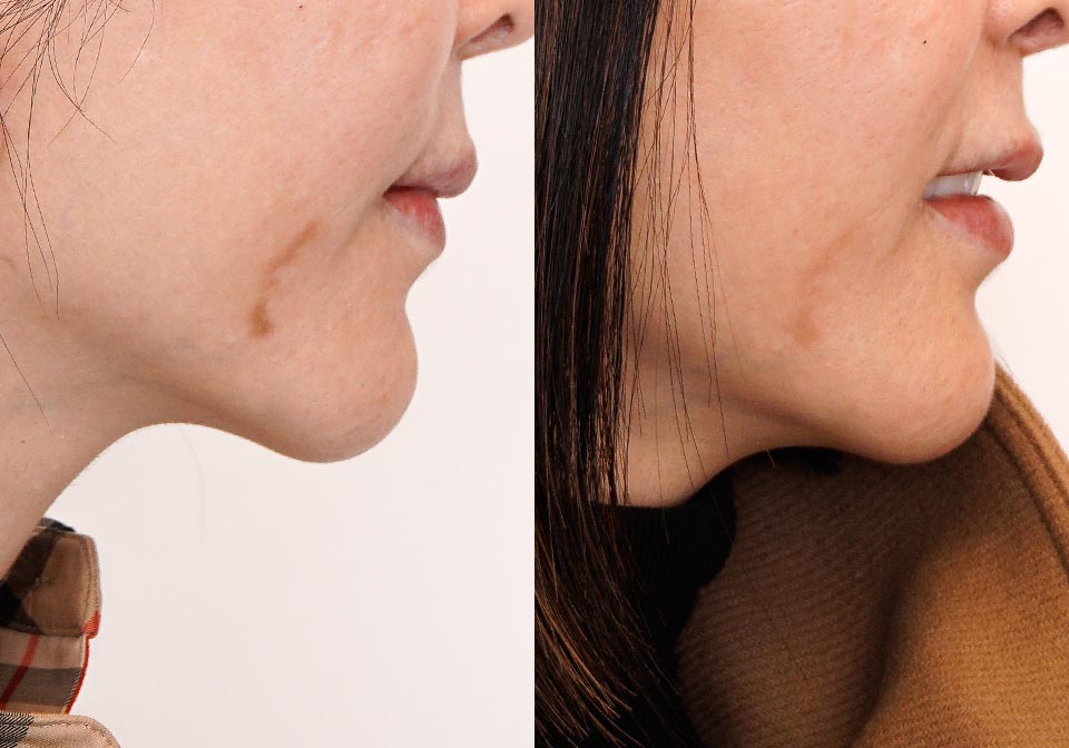 Laser Green Toning Before & After Gallery | Dr. Cory Torgerson