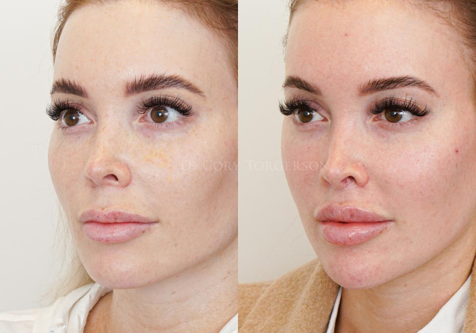 Lip Lift Before & After Gallery | Dr. Cory Torgerson