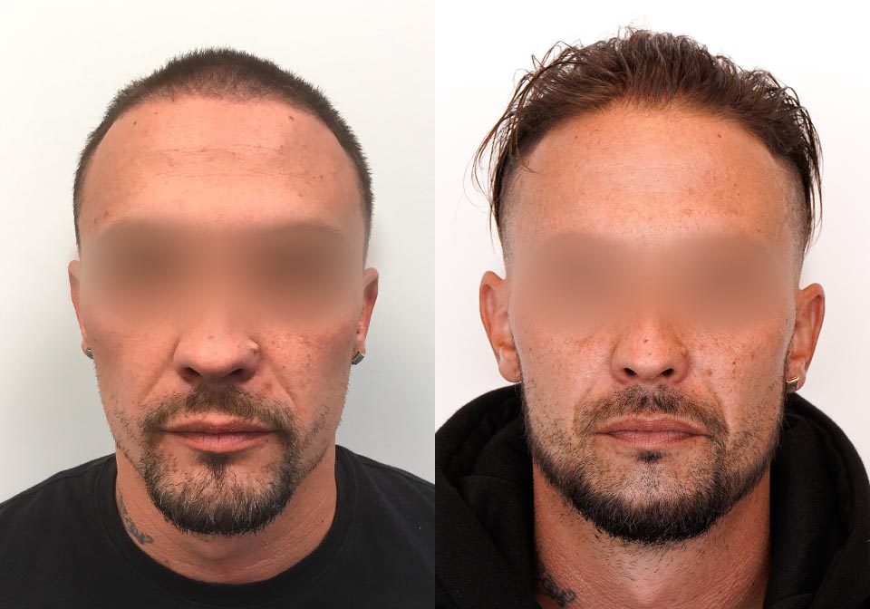 Beard Transplant Before & After Gallery | Dr. Cory Torgerson