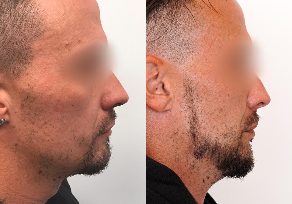 Beard Transplant Before & After Gallery | Dr. Cory Torgerson