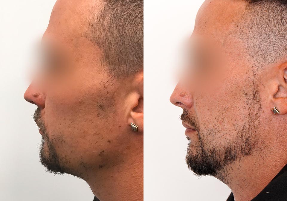 Beard Transplant Before & After Gallery | Dr. Cory Torgerson