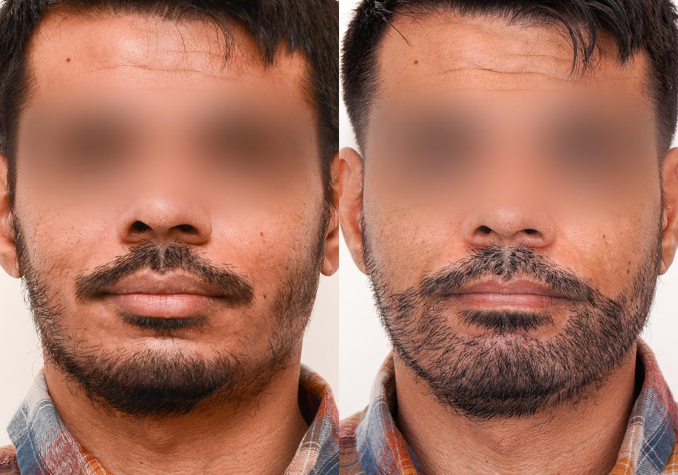 Beard Transplant Before & After Gallery | Dr. Cory Torgerson