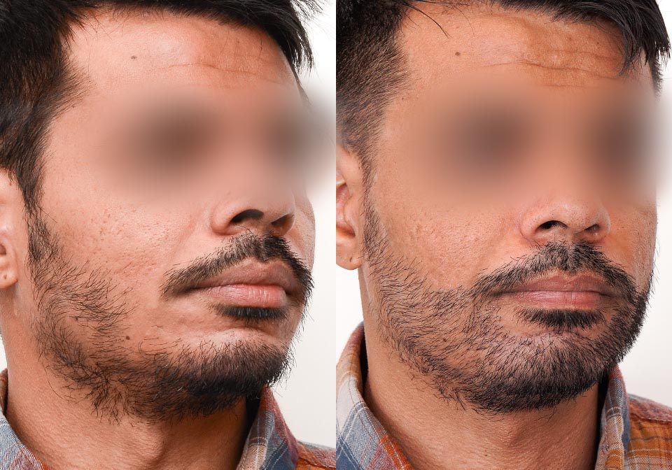 Beard Transplant Before & After Gallery | Dr. Cory Torgerson