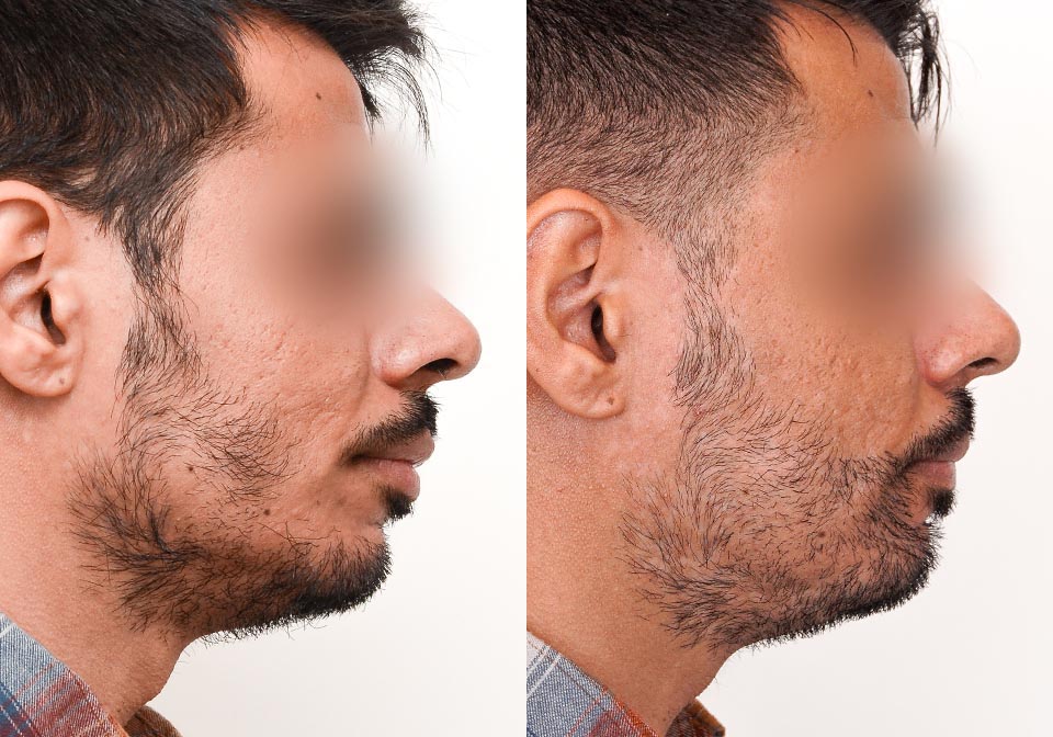 Beard Transplant Before & After Gallery | Dr. Cory Torgerson