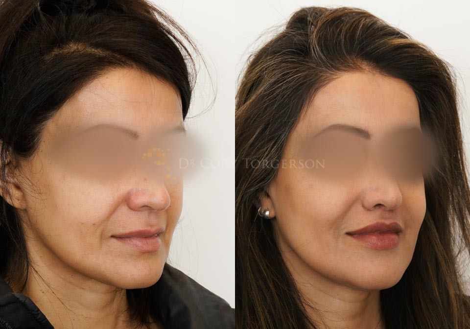 Lip Lift Before & After Gallery | Dr. Cory Torgerson