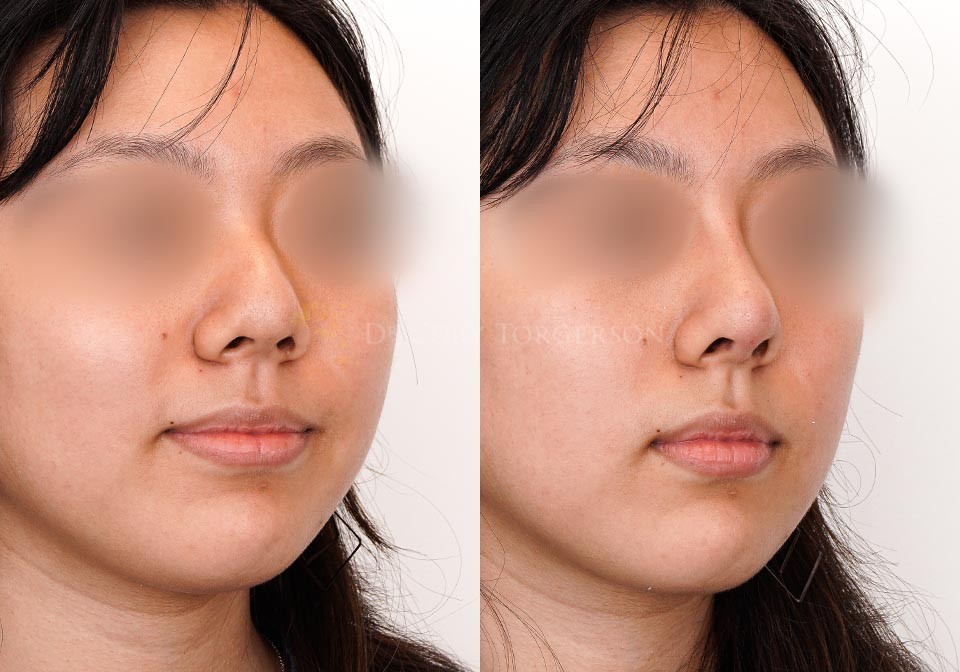 Non Surgical Nose Job Before & After Gallery | Dr. Cory Torgerson