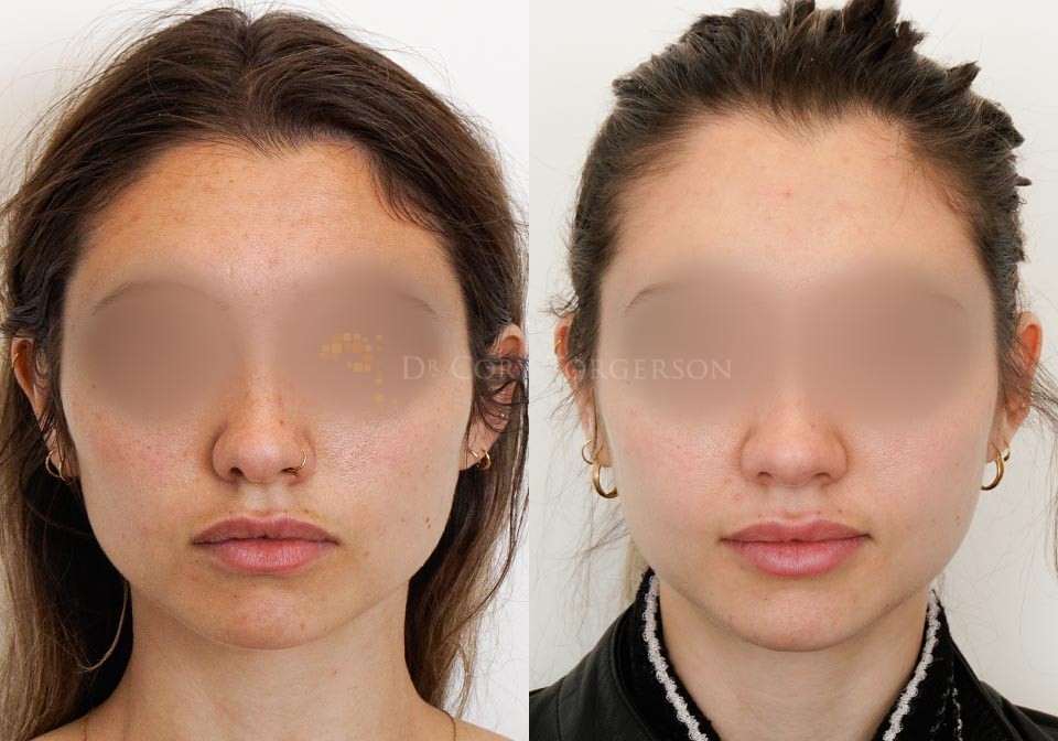 SilkPeel Before & After Gallery | Dr. Cory Torgerson