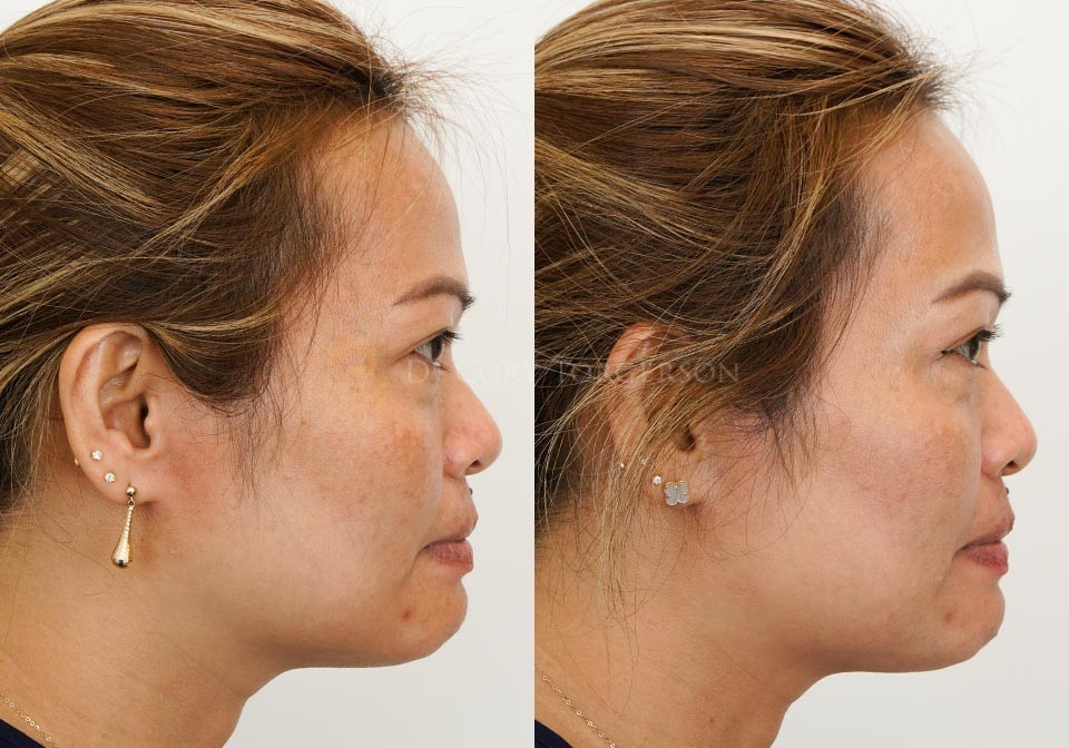 Laser Green Toning Before & After Gallery | Dr. Cory Torgerson