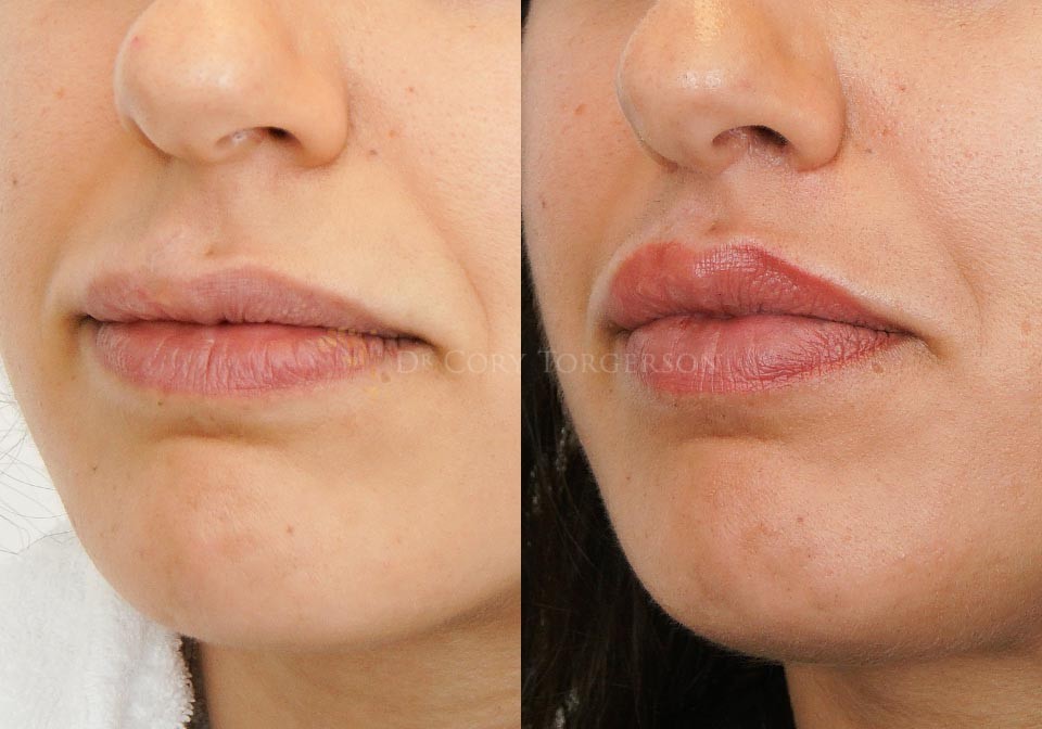 Lip Lift Before & After Gallery | Dr. Cory Torgerson