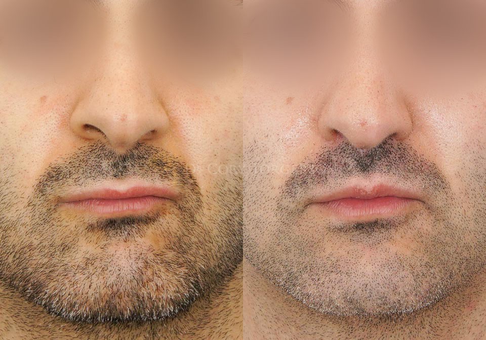 Lip Lift Before & After Gallery | Dr. Cory Torgerson