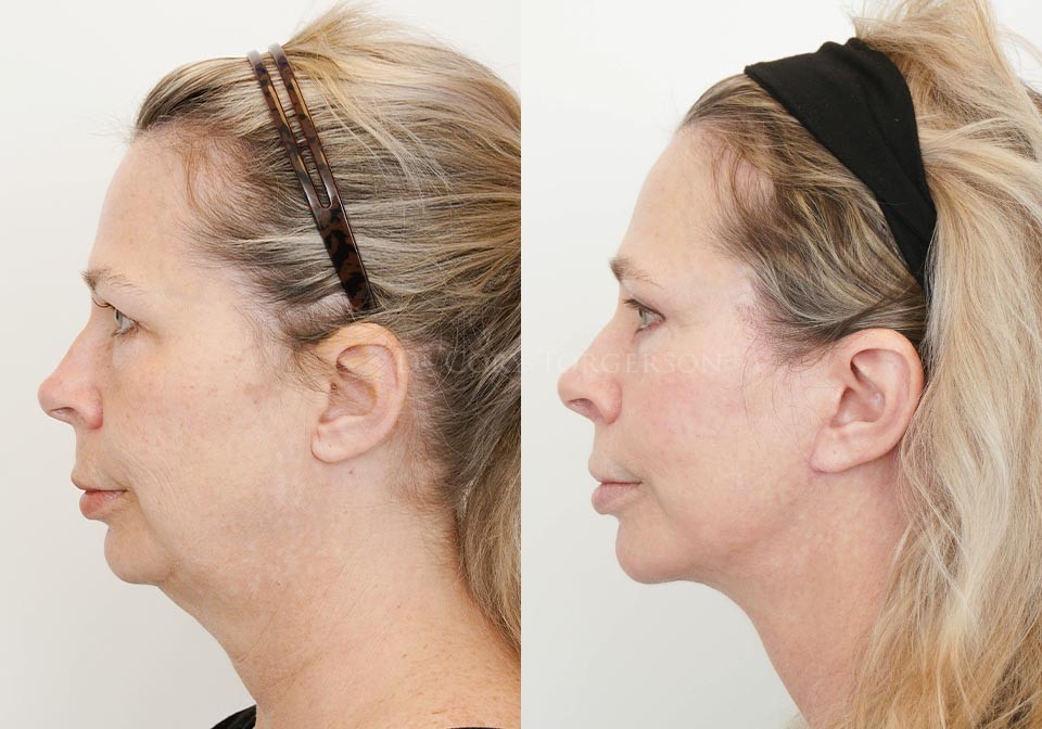 Neck Lift Before & After Gallery | Dr. Cory Torgerson