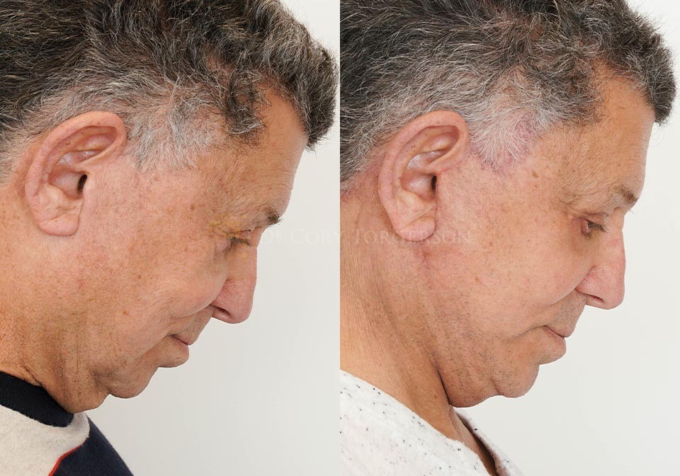 Neck Lift Photos | Before and After Profile Results