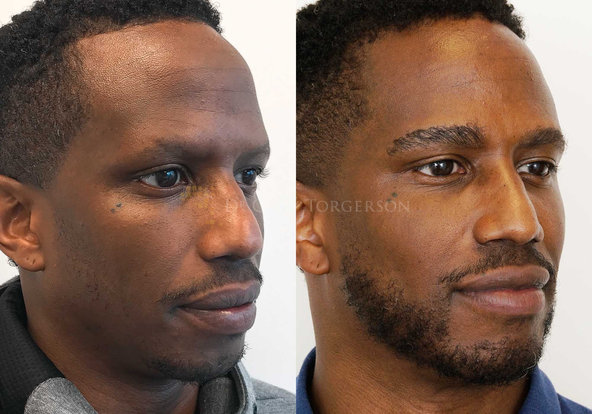 Beard Transplant Before & After Gallery | Dr. Cory Torgerson
