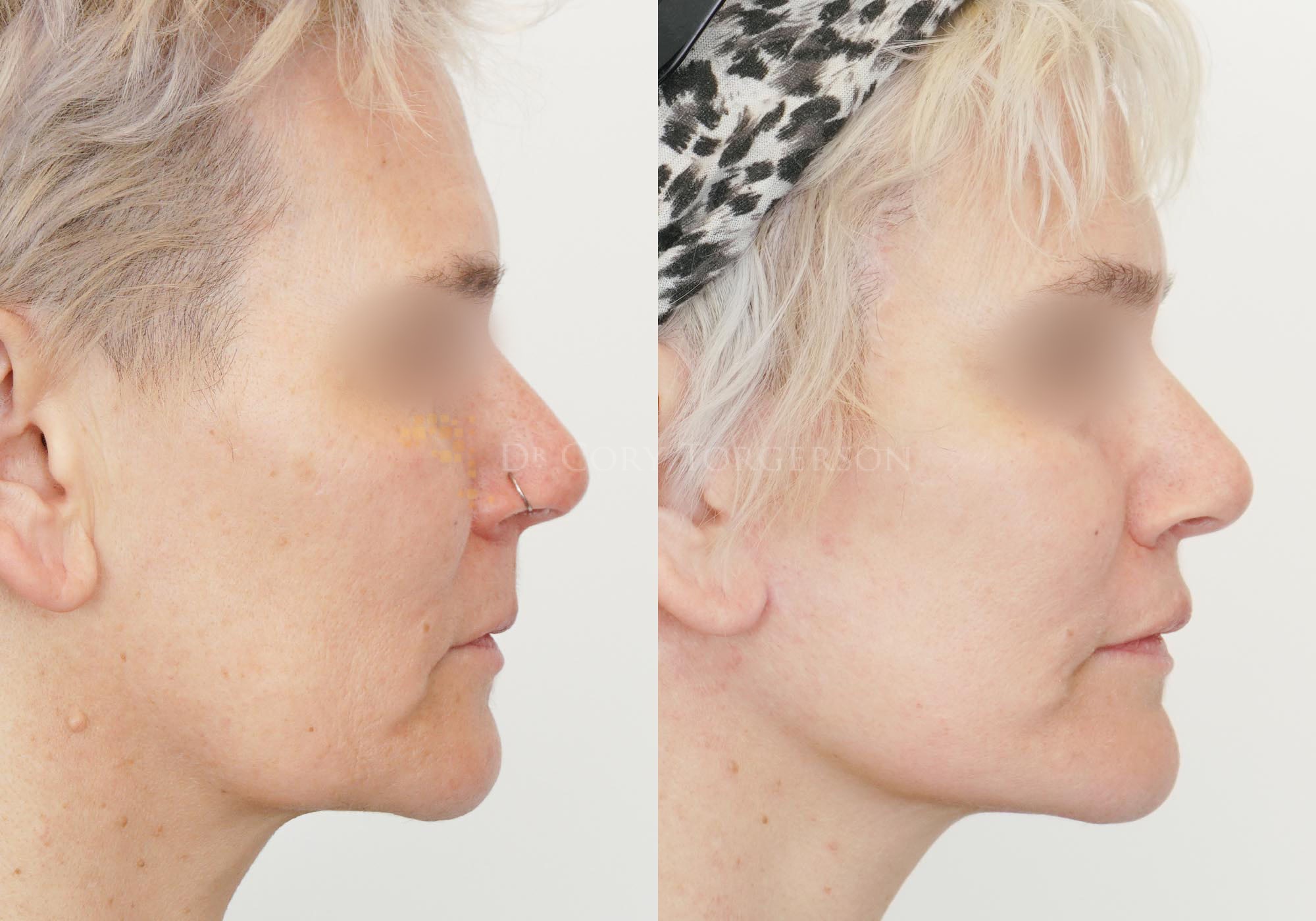 Mini Facelift in Toronto | Real Patient Photo Gallery