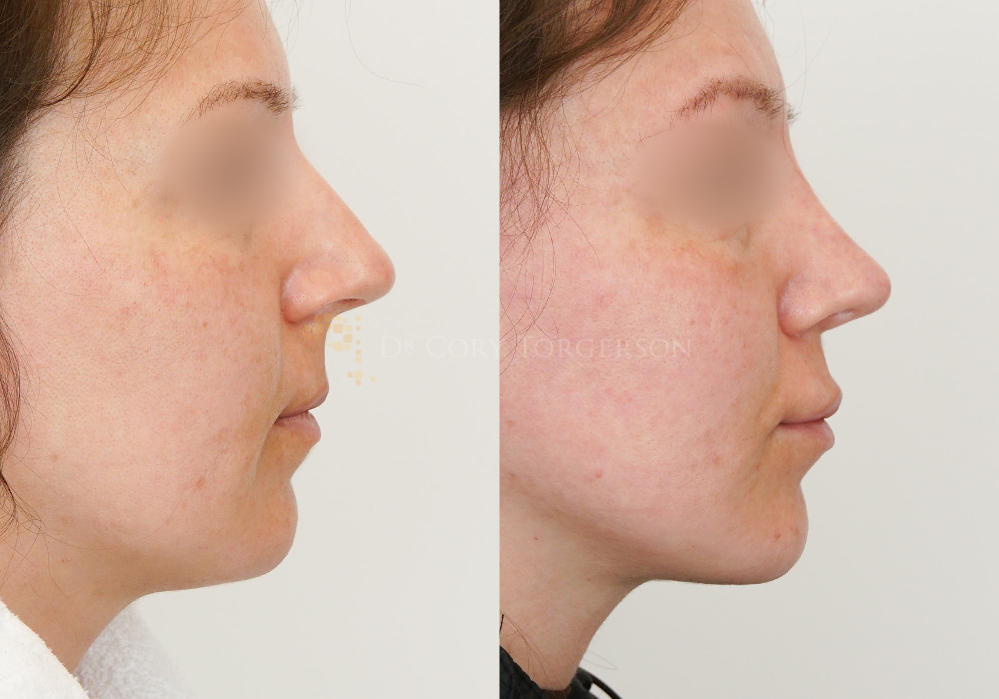 Facial Rejuvenation & Natural Lift Results | Dr. Torgerson, Toronto