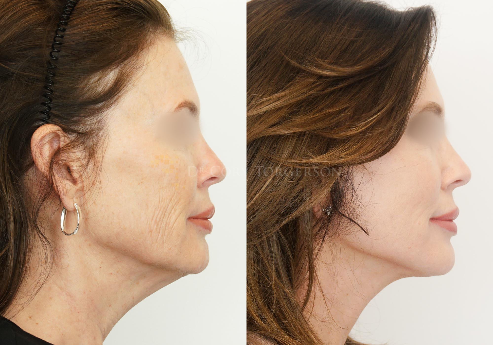 JPlasma Renuvion Before & After Gallery | Dr. Cory Torgerson