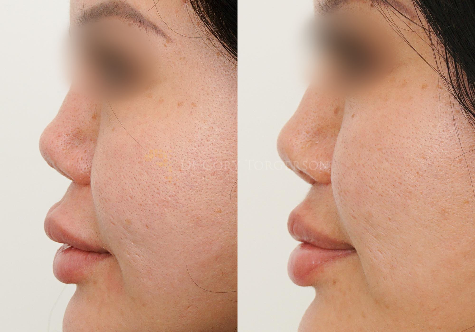 Lip Lift Before & After Gallery | Dr. Cory Torgerson