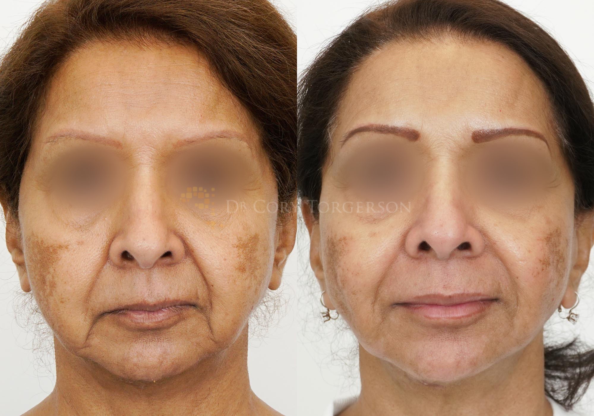 Facial Rejuvenation & Natural Lift Results | Dr. Torgerson, Toronto