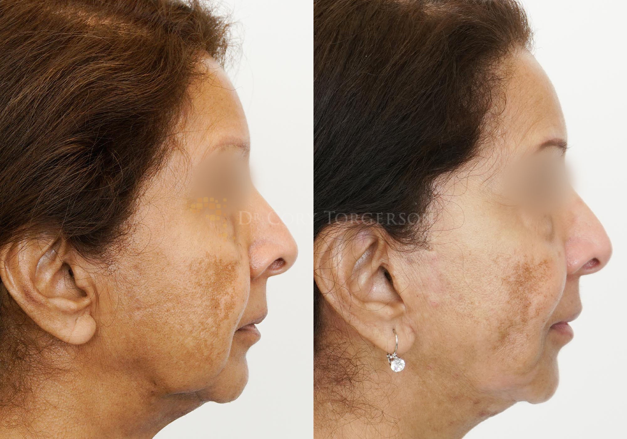 Facial Rejuvenation & Natural Lift Results | Dr. Torgerson, Toronto