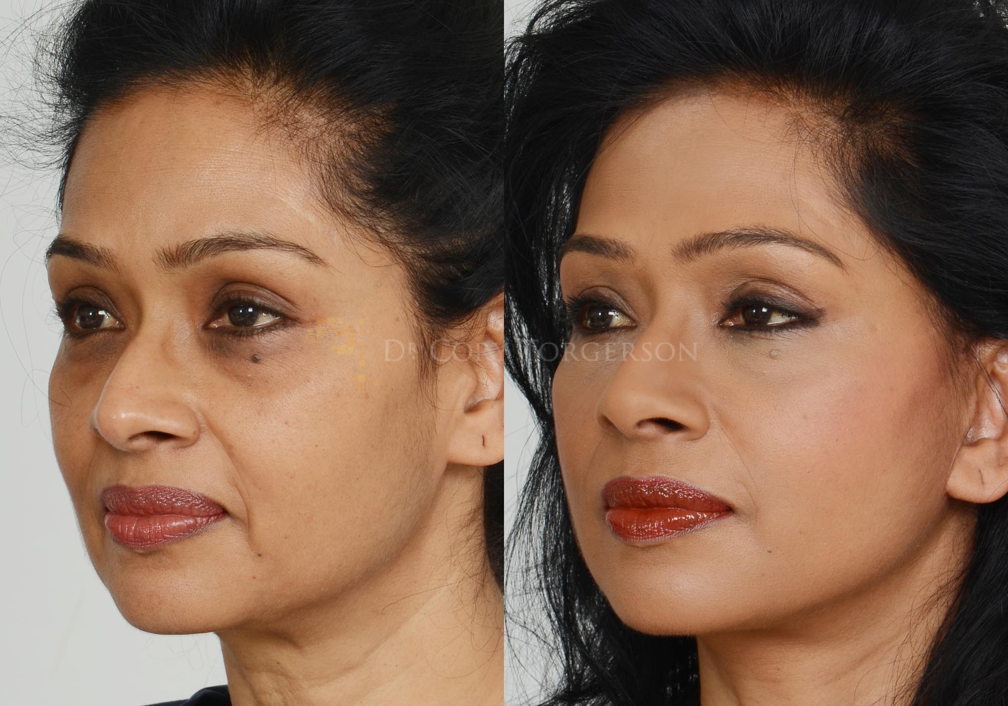 Mini Facelift Before & After Gallery | Dr. Cory Torgerson