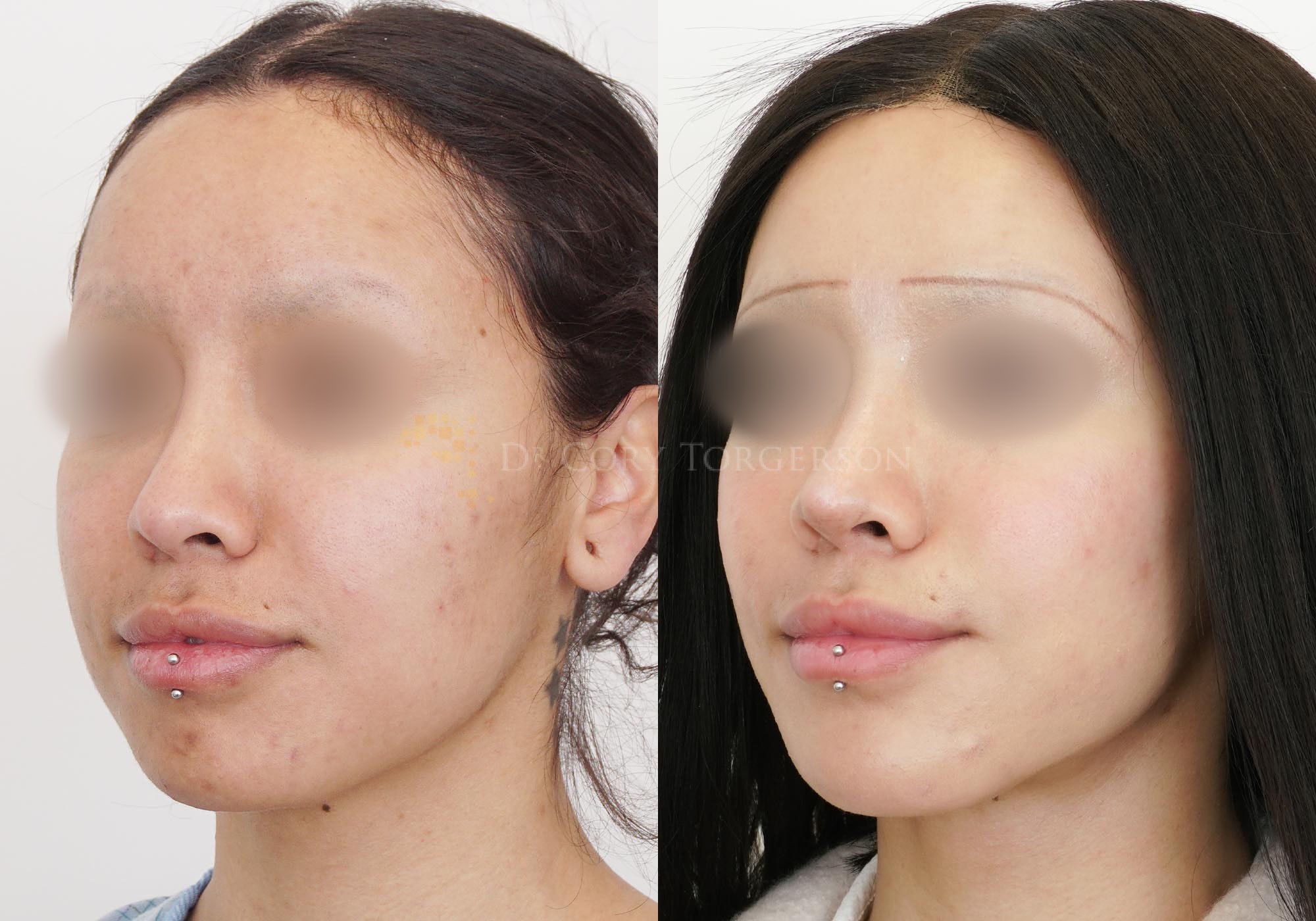Submental Liposuction Before & After Gallery | Dr. Cory Torgerson